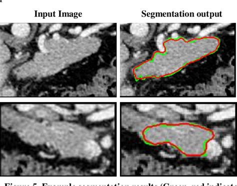 Figure 5 From Fixed Point Deformable U Net For Pancreas Ct Segmentation Semantic Scholar