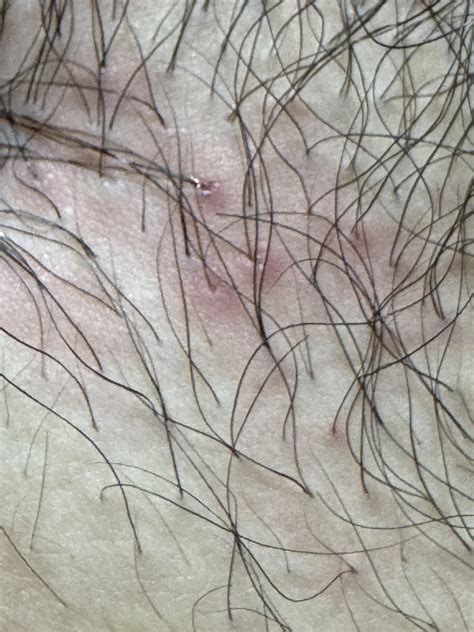 남성 성기 털에 빨갛게 뭐가 올라왔습니다 이게 뭔가요 ㅣ 궁금할 땐 아하