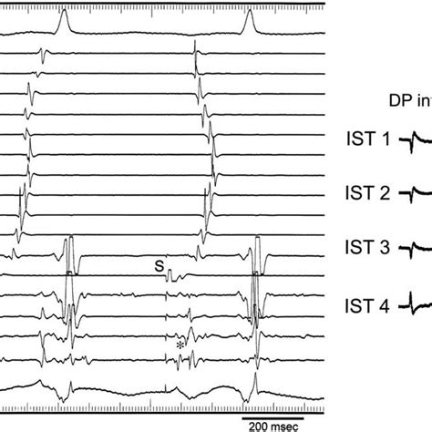 Pseudo Cavotricuspid Isthmus Cti Conduction Block In The Download Scientific Diagram