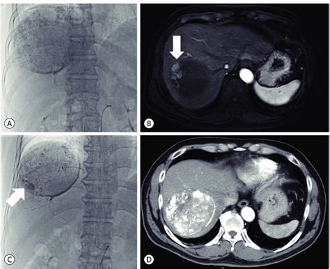 Angiogram Of The First Transarterial Chemoembolization Tace Showed A Download Scientific
