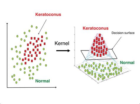 Artificial Intelligence In Keratoconus Ento Key