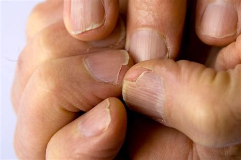 Brittle Nails Causes And Treatments Aleecare
