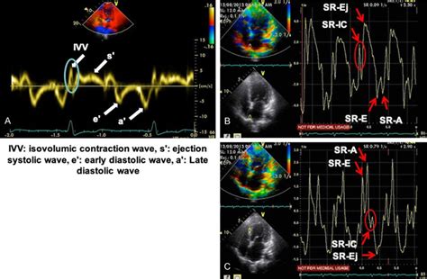 Isovolumic Velocities And Strain Rate Using Tissue Doppler Imaging A