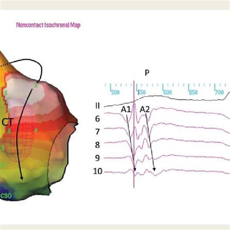 Right Anterior Oblique View Of Isochronal Map Of Atrial Tachycardia