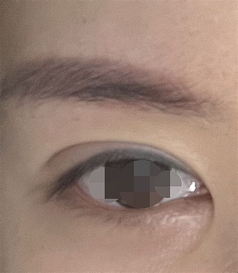 오래된 눈썹 문신 아이라인 문신 제거 대구 피부과 문신 제거 1회차and뷰티샵 문신제거 12회차 후기 비교 네이버 블로그