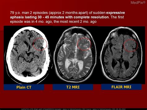 Lacunar Infarct Mri