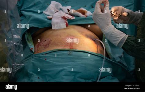 Laparoscopic Surgery Requires Stitches After Surgery After The Surgery