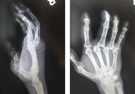 Metacarpophalangeal Joint Fracture