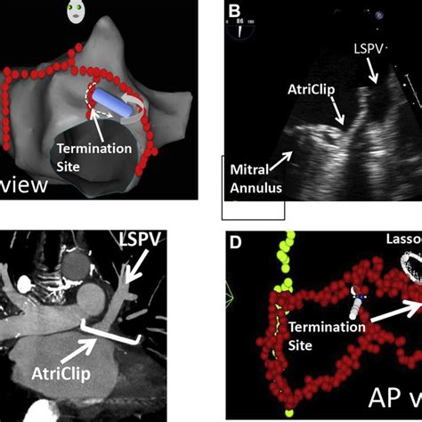 Pdf Successful Fluoroless Ablation Of An Incessant Atypical Atrial Flutter Attributed To