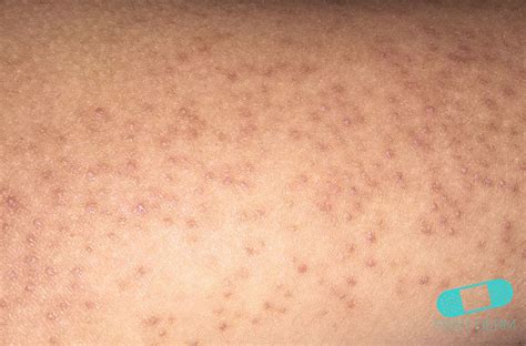 Keratosis Pilaris Back Keratosis Pilaris Treatment Nyc Manhattan