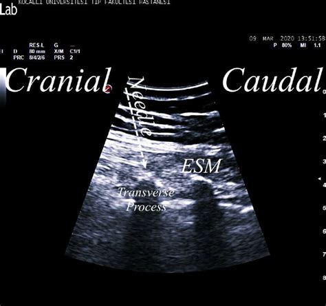 Ultrasound Image Of Erector Spinae Plane Block Esm Erector Spinae Muscle Download