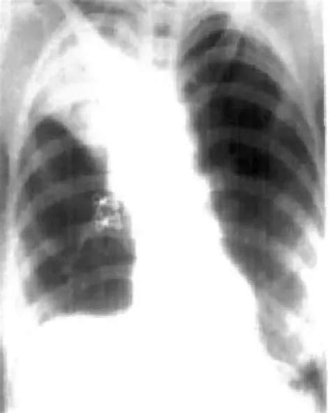 Аспирация презервативом во время минета и последствия⁠⁠