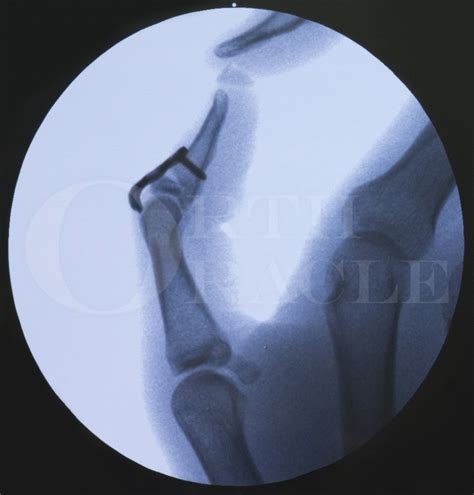 Technique Internal Fixation Of 5th Metacarpal Neck Fracture Synthes Lcp Plate Luanmd