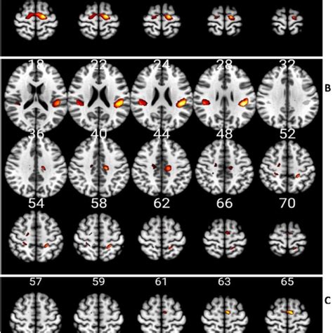 Results Of Conjunction Analysis The Statistical Parametric Maps Show Download Scientific
