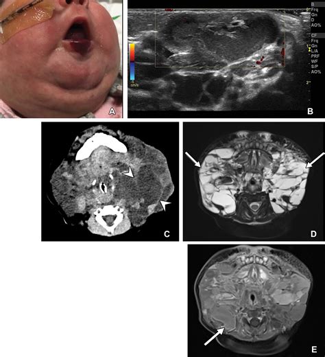 Vascular Anomaly Syndromes In The Issva Classification System Imaging Findings And Role Of
