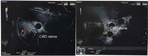 A Stone Of 7 7mm Seen In The Distal Part Of CBD The CBD Measures 6 1mm Download Scientific