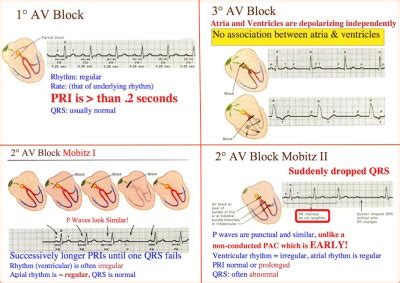 Atrioventricular Block AV Block Is A Type Of Hea Tumbex