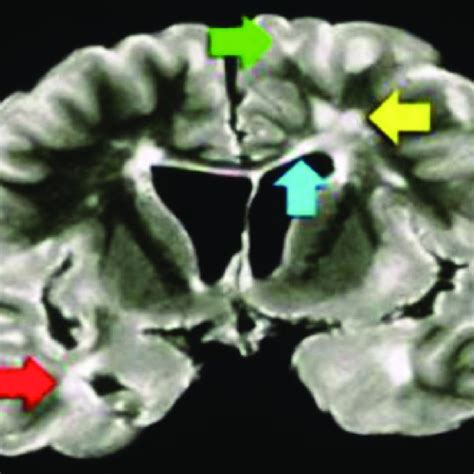Multiple Sclerosis Subtypes 11 Download Scientific Diagram