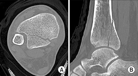 Posterior Malleolus Fragment Involves Approximately 41 Of The Distal Download Scientific
