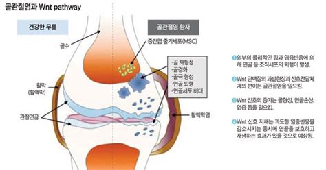 美 무릎 골관절염 신약에 대한 기술도입 계약 체결