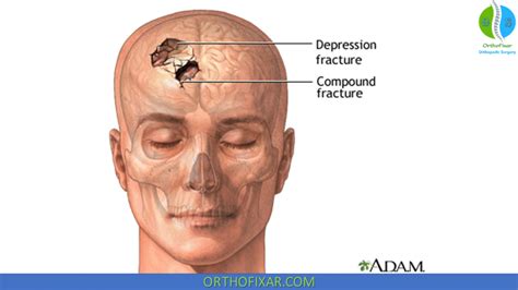 Skull Fracture Overview And Treatment Orthofixar