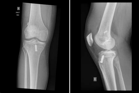 Hobart Knee Centre Bulk Billing Affordable Knee Surgery Tasmania