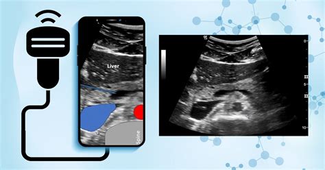 Inferior Vena Cava Ivc Assessment For Volume Status In Point Of Care Ultrasound Pocus