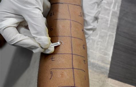 Dr Vaidehi Hardas Best Skin Allergy Testing Centre In Kandivali