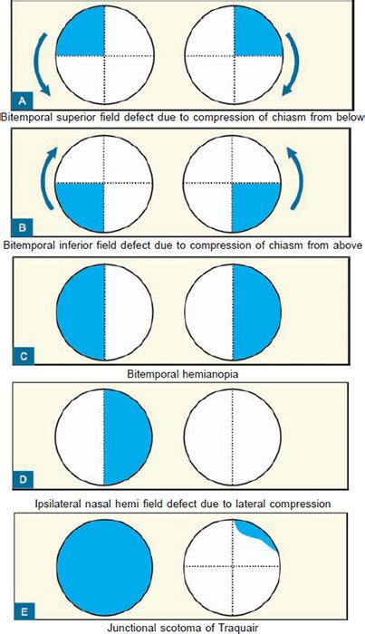 Quadrantanopsia Icd