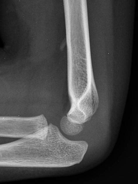 Supratrochlear Spur Pacs