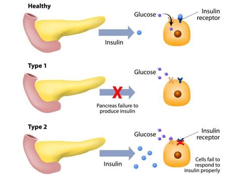 Gestational Diabetes A Novel Detection Strategy Research Outreach