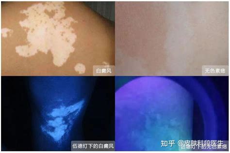 去医院照了伍德灯 Wood灯 怎样才能确定就是白癜风呢 知乎