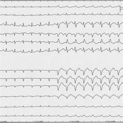 A 12‐lead Ecg Demonstrates The Onset Of Left Bundle Branch Block Download Scientific Diagram