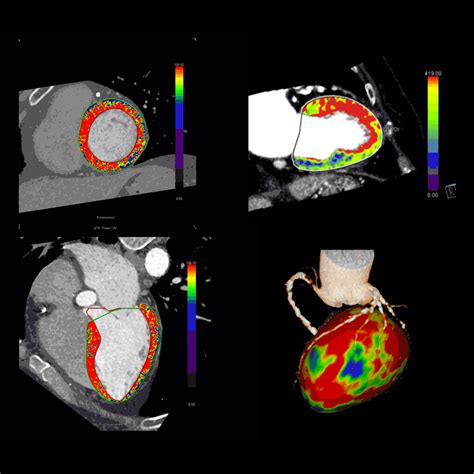ct cardiovascular imaging