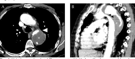 Figure From Chronic Type B Aortic Dissection Images Of An Unusual Clinical Presentation