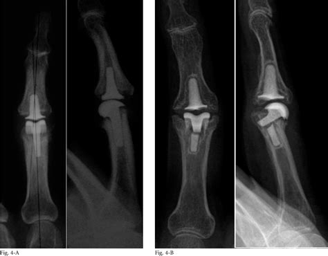 Proximal Interphalangeal Joint Semantic Scholar