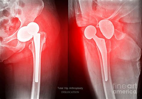 Dislocation After Total Hip Arthroplasty 2 By Samunellascience Photo Library