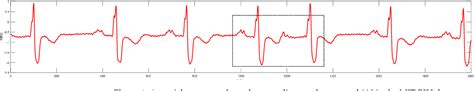 Figure 1 From An Arrhythmia Classification Model Based On A Cnn Lstm Se