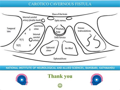 Caroticocavernous Fistula Ccf Pptx