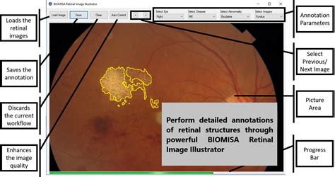 Oct Image Analysis System For Grading And Diagnosis Of Retinal Diseases And Its Integration In I