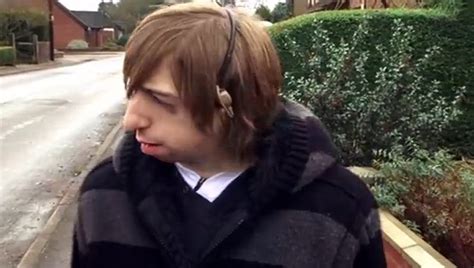 Treacher Collins Syndrome Pictures Symptoms Causes Treatment