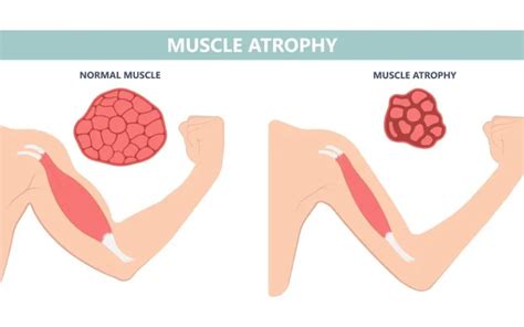 Muscle Atrophy Types Causes And Symptoms