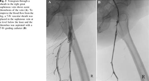 Venogram Through A Sheath In The Right Great Saphenous Vein Shows Acute