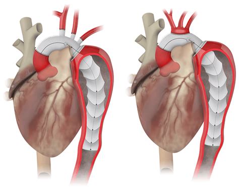 Thoraflex™ Hybrid Terumo Aortic