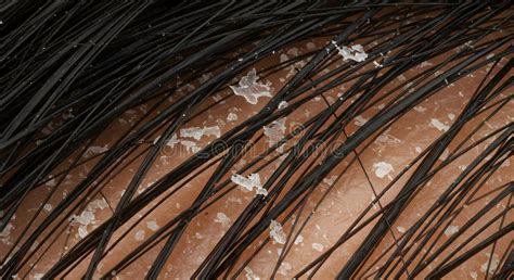 Closeup Detailed View Of Dandruff On Dark Hair Scalp A Microscopic Look At Seborrheic