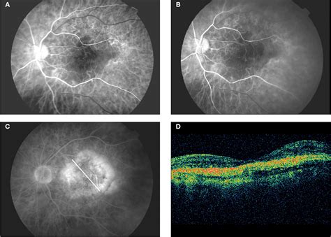 Figure 2 From Intravitreal Bevacizumab For The Treatment Of Feeder Vessel Of Subfoveal Choroidal