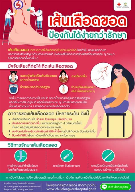 Thai Red Cross Society On Twitter เส้นเลือดขอด เกิดจากการที่เส้นเลือดดำไหลเวียนผิดปกติ