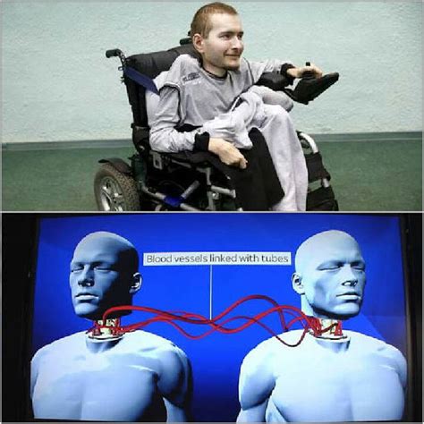 Head Transplant Medizzy