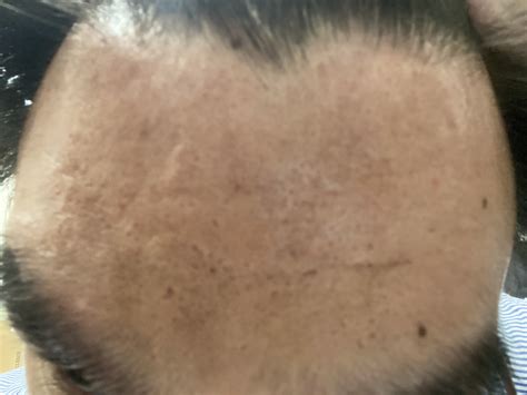 Dark Patch On Forehead Melasma Symptoms Diagnosis And Treatments