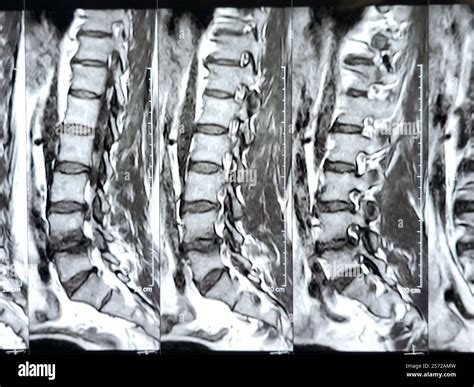 Magnetic Resonance Imaging Mri Of The Lumbosacral Spine Shows